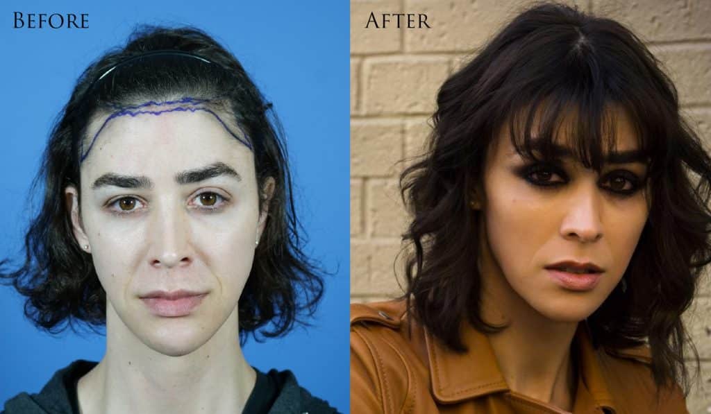 Transgender Hair Restoration in Seattle & Portland Portland Oregon ...