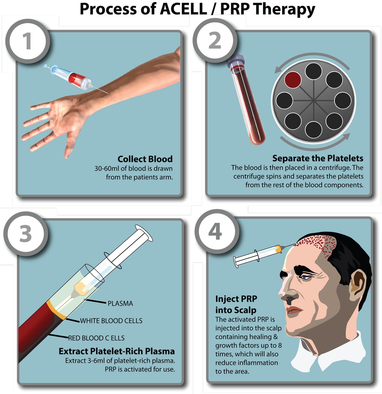 Understanding Platelet Rich Plasma Therapy (PRP)